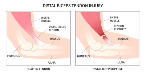 Distal Biceps Tendon