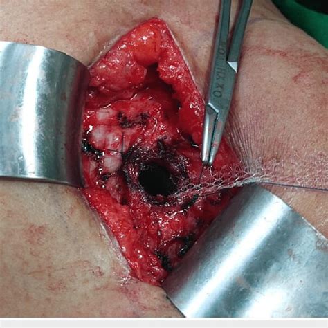 Flanges Of Patch Being Sutured At The Edges Of The Hernia Defect Using