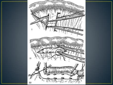 Enterectomy Online Presentation