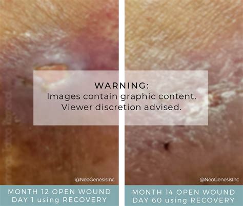 Pressure Ulcers Archives Neogenesis