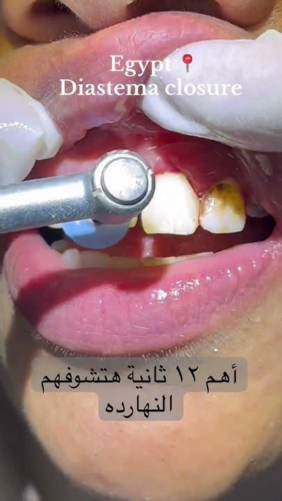 تحول لايصدق في الاسنان الامامية 🙀dentalcare Estheticdentist