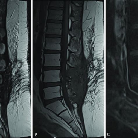 Postoperative Mri Of The Lumbar Spine Sagittal T2 Weighted A