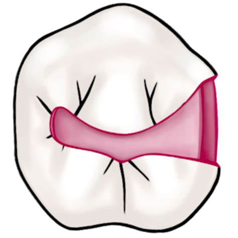 Class Ii Amalgam Preparation My Dental Key