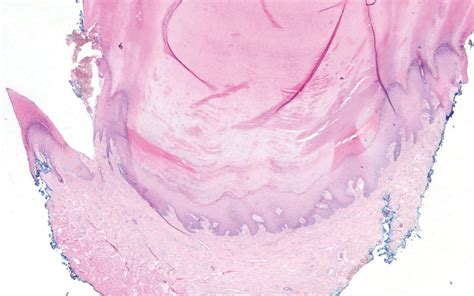 Filiform Papule Foot Planter