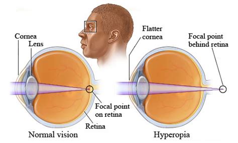 Difference Between Near Sightedness And Far Sightedness Difference Between Difference