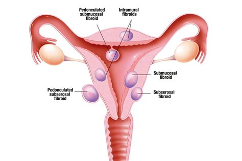 The Four Types Of Fibroids Responsum For Fibroids