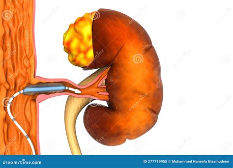 Stent Angioplasty Peripheral Artery Disease Stock Illustration