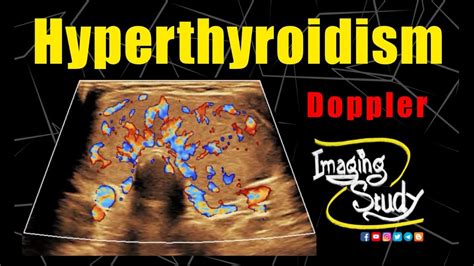 Hyperthyroidism Thyrotoxicosis Doppler Ultrasound Case 294 Youtube