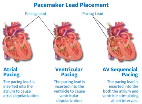 Arrhythmia Recognition Part 2 Clinical View