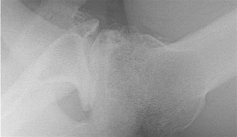 Uw Shoulder And Elbow Academy Does Glenoid Version Need To Be Corrected In Anatomic Shoulder