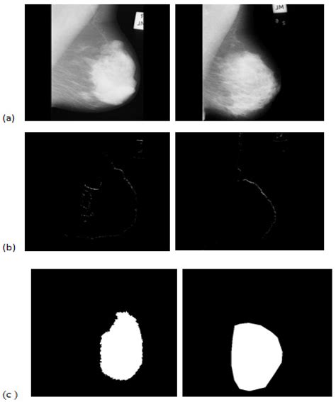 Future Fusion Unet R2u Net Deep Learning Architecture For Breast Mass Segmentation