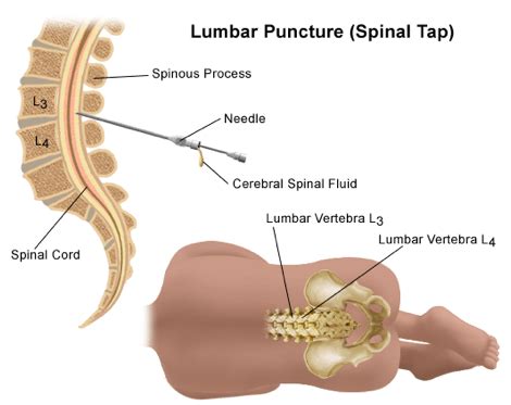 Lumbar Puncture