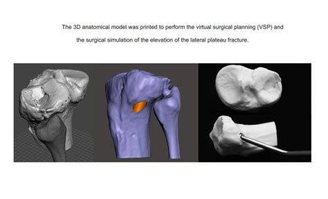 Overview Of 3d Anatomical Model Printing Jmdh