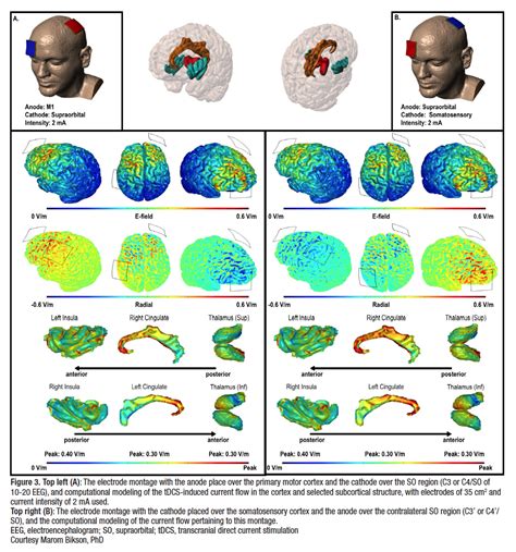 Transcranial Direct Current Stimulation