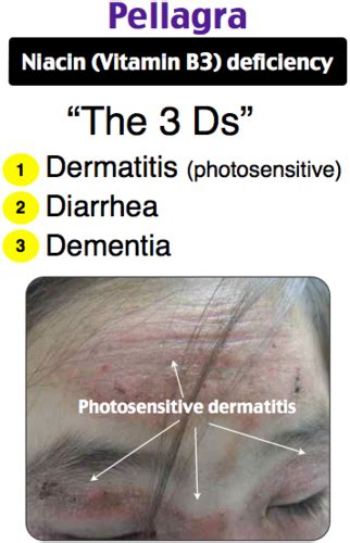 Polyneuropathy And Mononeuritis Multiplex Flashcards Quizlet