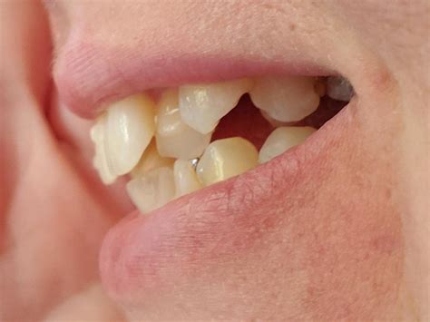 Extractions And Ipr Invisalign