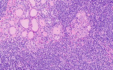 Histology Of Hashimotos Thyroiditis My Endo Consult