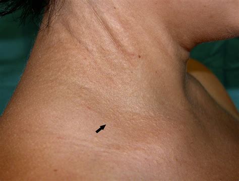 Pseudoxanthoma Elasticum Eye