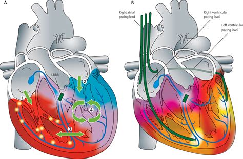 Implantable Cardioverter Defibrillator Vs Pacemaker