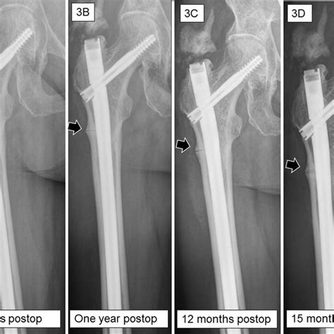 Bisphosphonate Associated Periprosthetic Femur Fractures After Total Download Table
