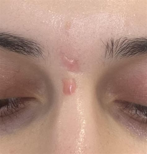 Laser Or Steroid Injection For Hypertrophic Scar London R