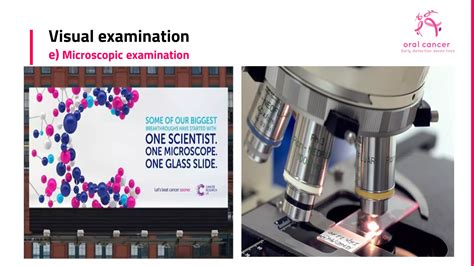 Early Cancer Detection Oral Cancer Pdf Dental Health Diseases And Conditions