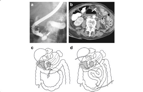 A Fluoroscopy Shows Extraintestinal Leakage Of The Contrast Medium B Download Scientific
