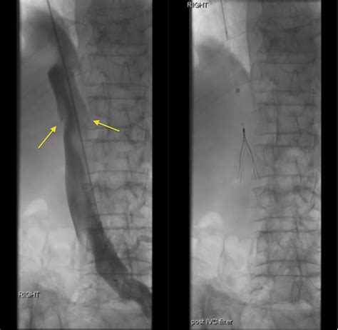 Ivc Filter Insertion Radiology At St Vincents University Hospital