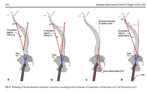 As矢状面的截骨矫形设计！ 德医医学 助力医学教育发展！