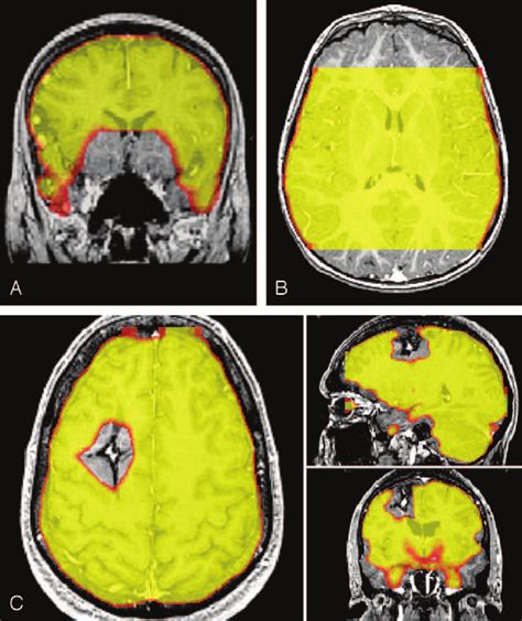 Types Of Susceptibility Artifact A Type I Signal Intensity Loss In Download Scientific