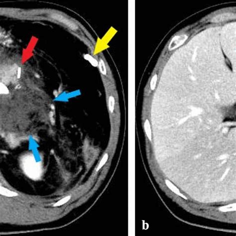 A Contrast Enhanced Computed Tomography Examination On Day After Download Scientific Diagram