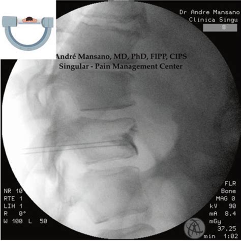 Splanchnic Block And Radiofrequency Ablation Nysora