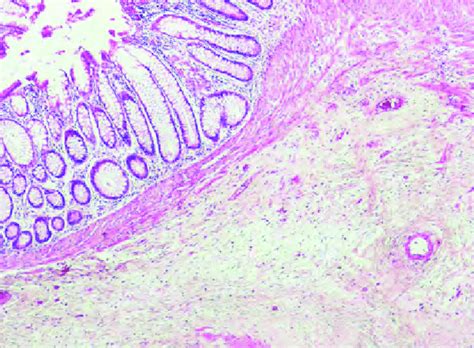 Complete Pathologic Response After Neoadjuvant Chemoradiotherapy Hande