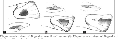 Figure 2 From A Comparative Evaluation Of The Effect Of Different Access Cavity Designs On Root