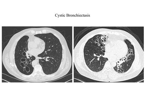 Differential Diagnosis Of Pulmonary Cyst 1 Bullous Emphysema 2