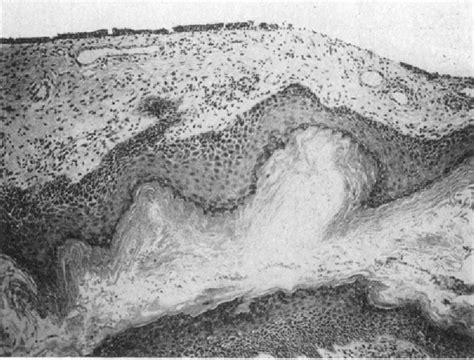 Cholesterol Granuloma Semantic Scholar
