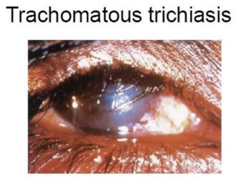 Chlamydia Flashcards Quizlet