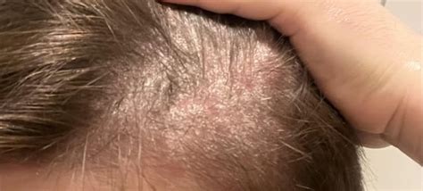 Dry Scalp And Dandruff Tried Ketoconazole Shampoo And Tgel Shampoo With