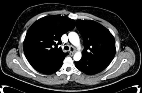Technical Options In Carinal Resection And Reconstruction Ctsnet