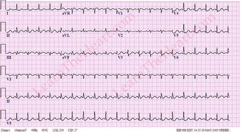 Atrial Flutter With 21 Conduction Ecg Example 1 Learn The Heart