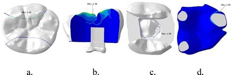 Figure 1 From Stress Distribution Of Endodontically Treated Tooth Mod Cavity Restored With
