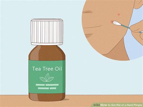 Ways To Get Rid Of A Hard Pimple WikiHow Ways To Get Rid Of A Hard Pimple WikiHow