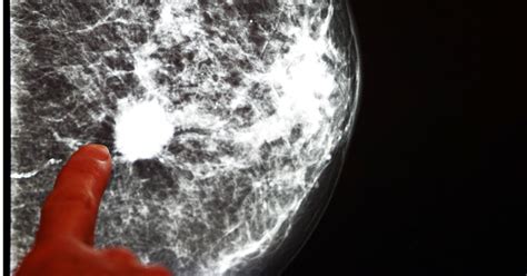 Novartis Ups Pace On Ibrance Challenger As Ribociclib Trial Stopped Early