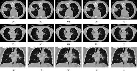 Figure 1 From Automated 3 D Segmentation Of Lungs With Lung Cancer In
