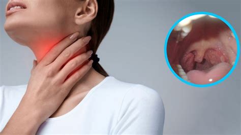 Ganglios Linfáticos Qué Es Síntomas Y Tratamiento Top Doctors