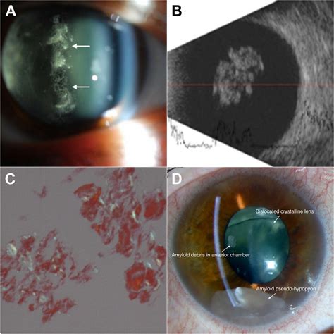 Pseudohypopyon In An Adult With Amyloidosis Ophthalmology Glaucoma
