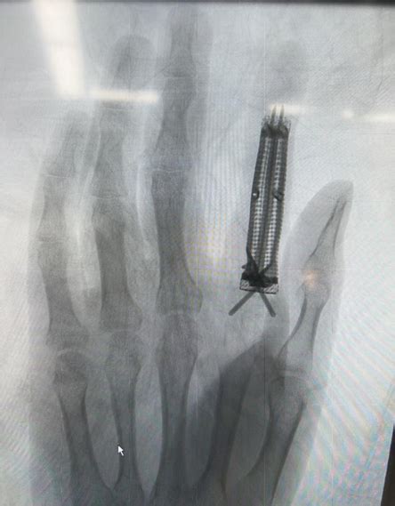 3d Printed Titanium Alloy Prosthesis To Treat Finger Bone Defects Greatlight Cnc Machining