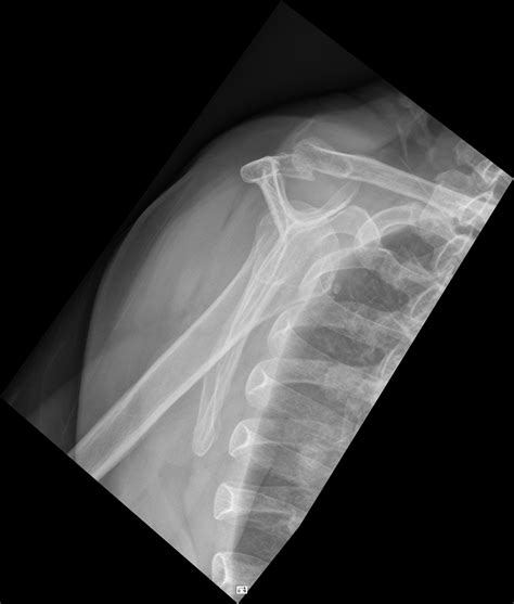 Inferior Glenoid Fracture X Ray At Elvira Pierce Blog