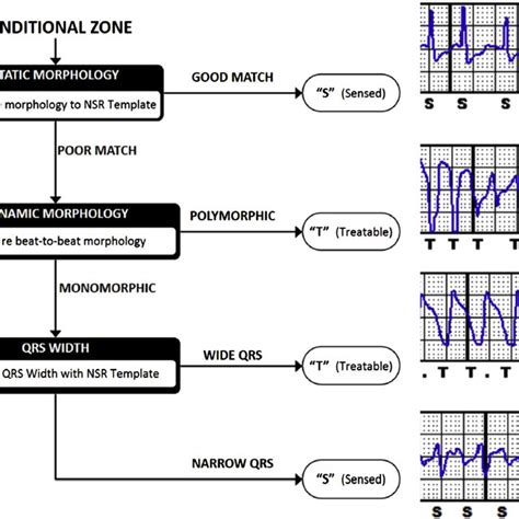 Algorithm For Classifying Arrhythmias Within The Subcutaneous
