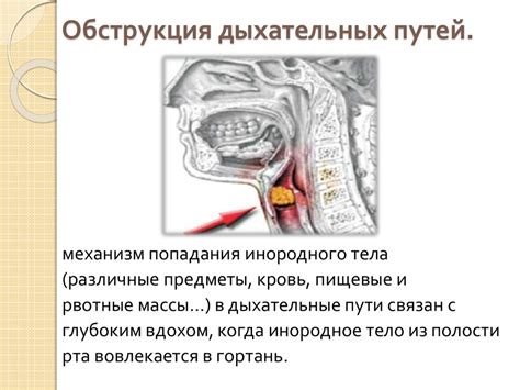 Помощь при обструкции дыхательных путей Приём Хеймлиха презентация онлайн